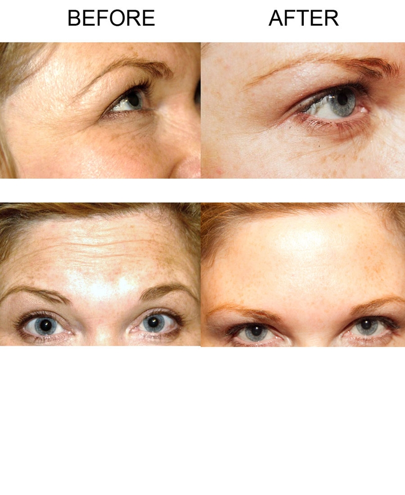 Extreme Beauty - Botox