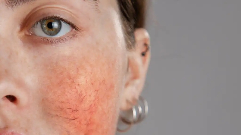 What exactly is rosacea and how can it be treated?