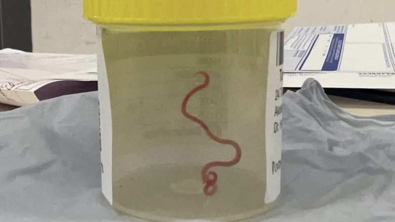 Australian doctors find live worm in woman's brain