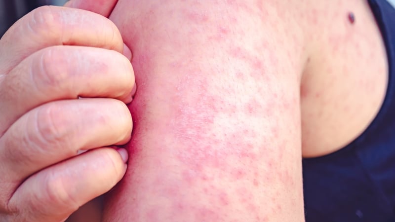 Why are we now seeing an 'alarming rise' in measles cases?