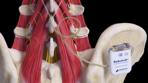 Mainstay Medical raises $125m in new funding round