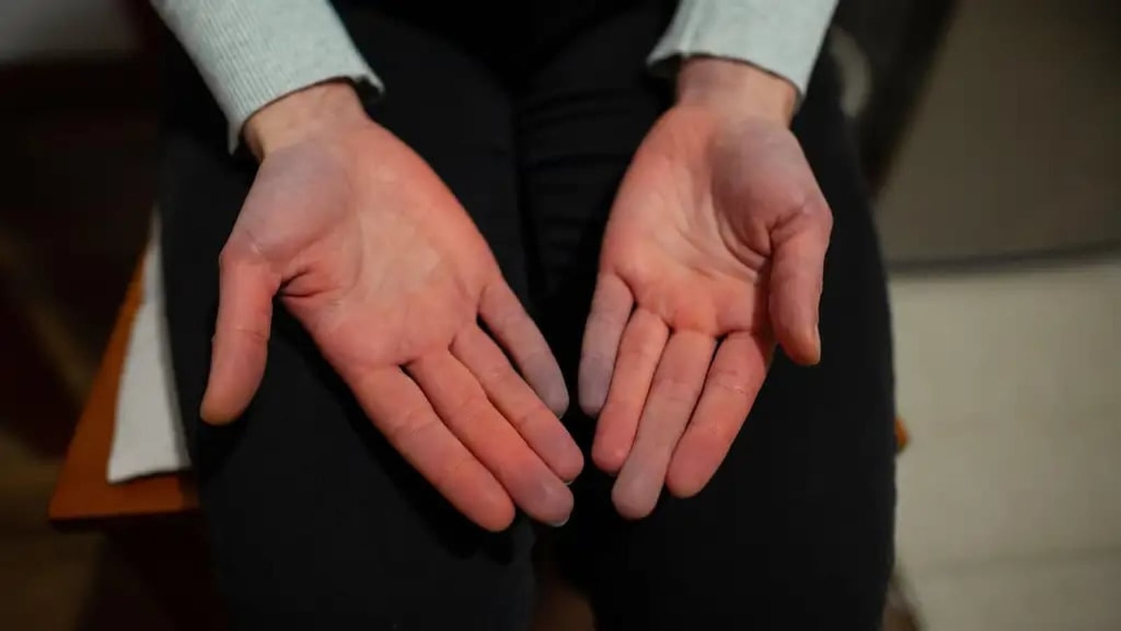 Natural ways to help circulation problems